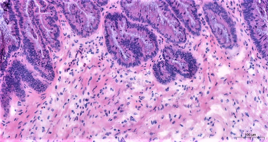 Peritoneal Metastases - Manchester Cancer Research Centre